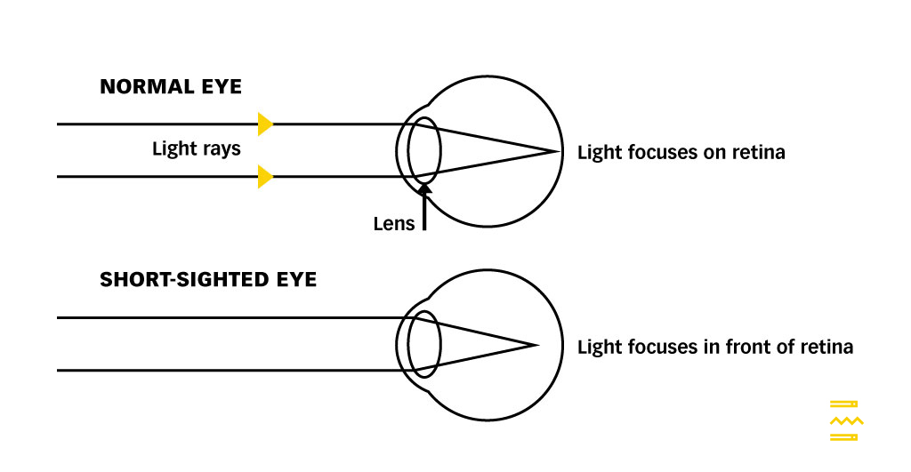 A foresight on short-sightness: Slowing the progression of Myopia ...