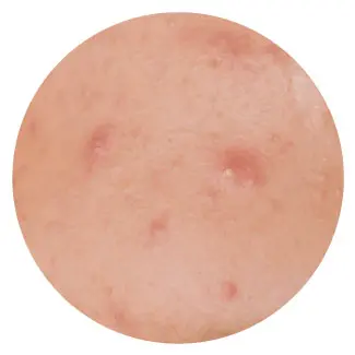 Learning about Acne – PULSE TCM Clinic