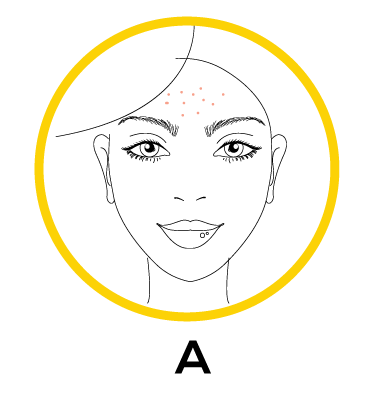 TCM Acne Management Program Singapore – PULSE TCM