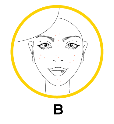 TCM Acne Management Program Singapore – PULSE TCM