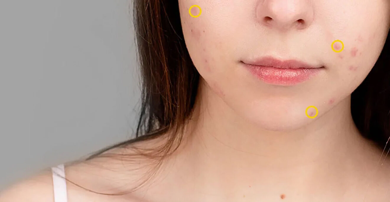 TCM Acne Face Map: What Your Pimples Are Telling You | PULSE TCM Clinic ...