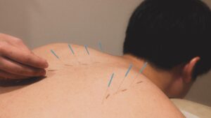 Acupuncture | PULSE TCM Clinic Singapore – PULSE TCM Clinic