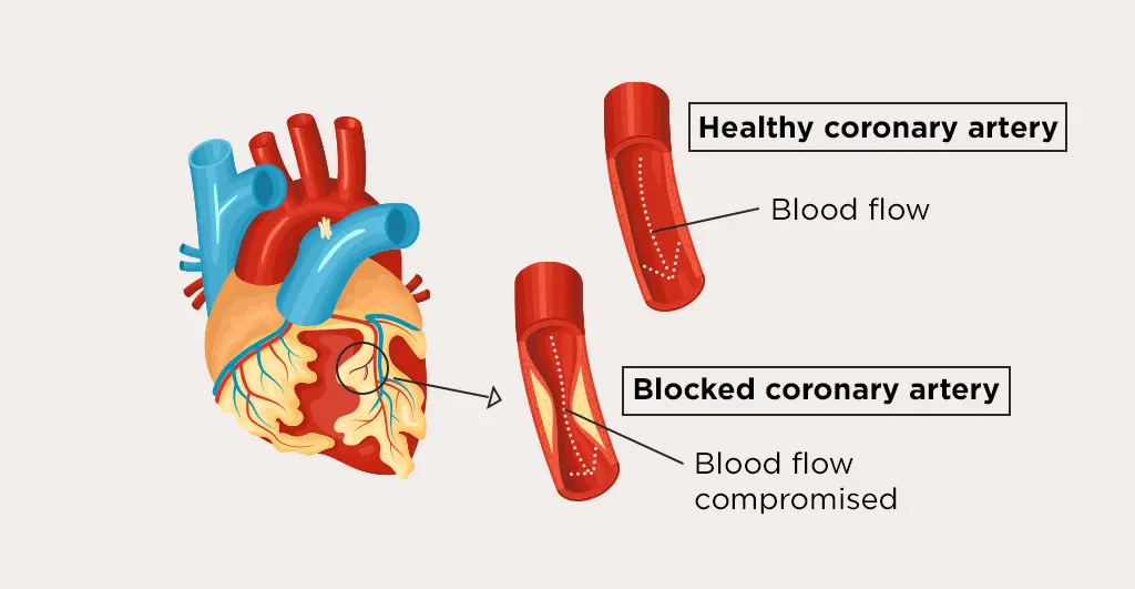 Qi stagnation and blood stasis type coronary heart disease (Part 1 ...