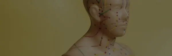 Acupuncture | PULSE TCM Clinic Singapore – PULSE TCM Clinic