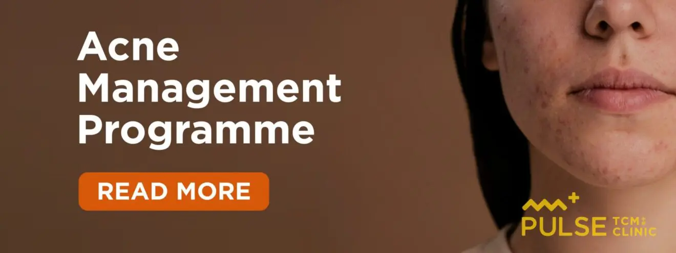 Acne Face Map: What Your Pimples Are Telling You – PULSE TCM Clinic