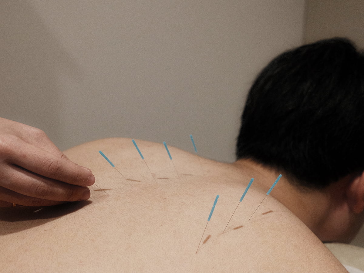 Acupuncture Solution – PULSE TCM